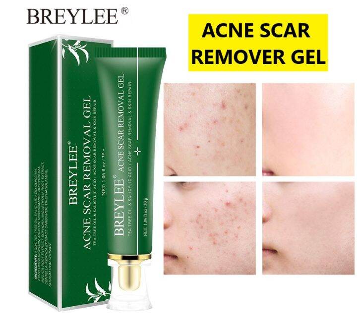 Breylee Acne Scars Removal Gel anti acne scars Whitening skin 30g | Lazada PH