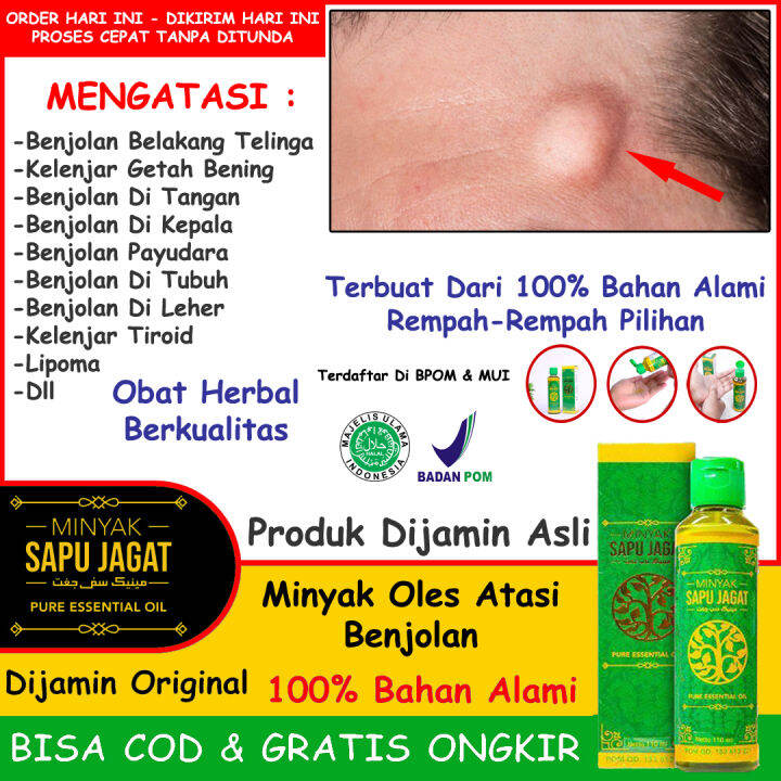 Obat Oles Benjolan Penghilang Lipoma Di Tubuh Tangan Kepala Payudara ...