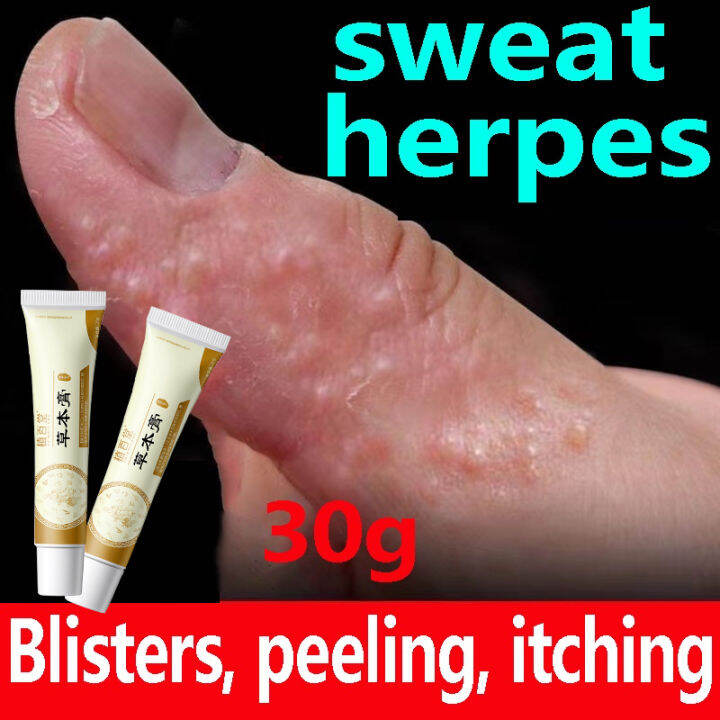 Eczema ointment Cowhide Fresh Moss psoriasis Eczema ointment ...