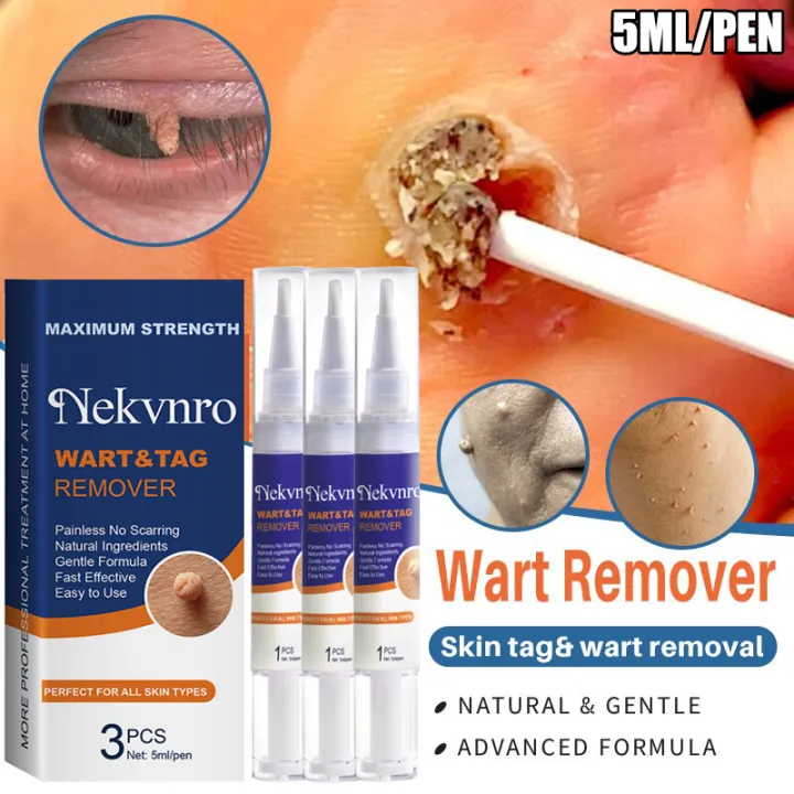 Idun Mole Remover Pen 3ml/5ml Warts And Skin Tags Remover Pen Warts ...