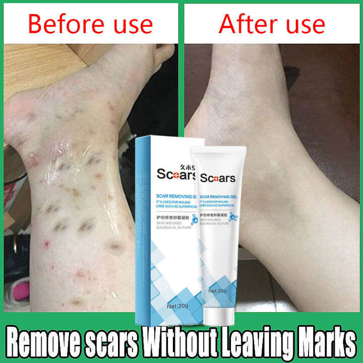 Scar Remover Gel Cream Stretch Marks Removal Ointment Skin Repair Scars ...