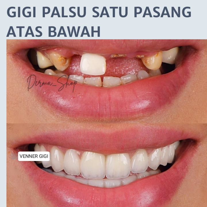 Paket gigi palsu atas bawah Gigi palsu permanen kuat tahan lama ori ...