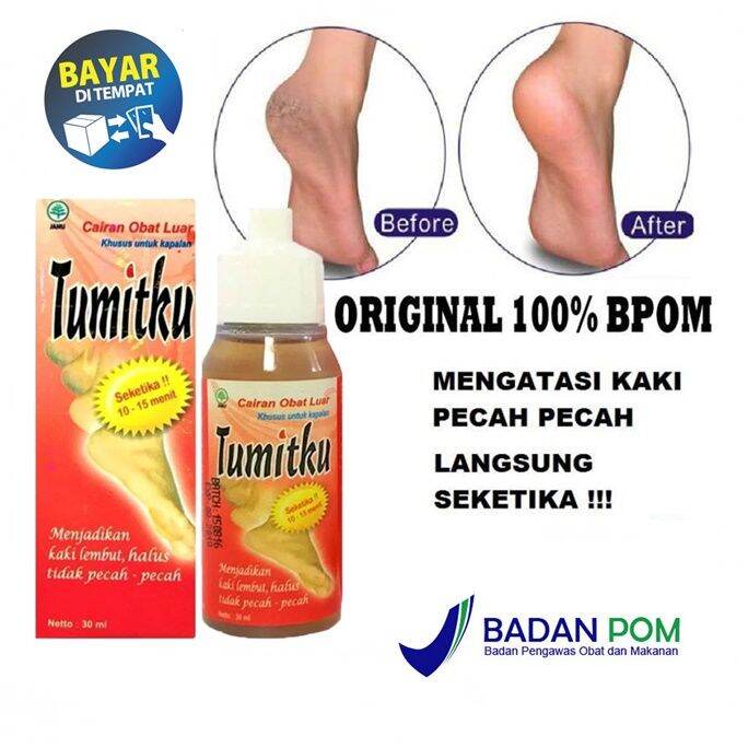 TUMITKU Obat Oles Untuk Mengatasi Kaki Pecah-pecah dan Kapalan Secara ...