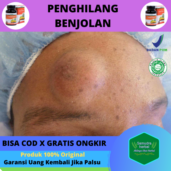 Obat Penghancur Benjolan Di Jidat, Cara Menghilangkan Benjolan Kista Di ...