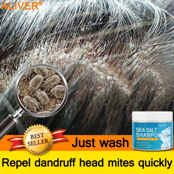 Aliver Anti Dandruff Shampoo Solve Dandruff Itch Remove Mites Scalp
