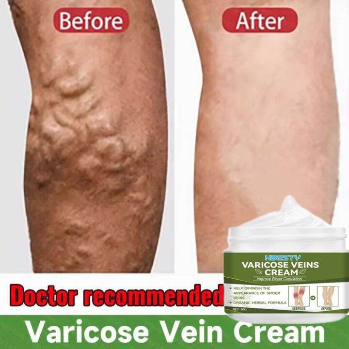 🔥Effective in 7 days🔥varicose vein removal Treatment Healing cream ...