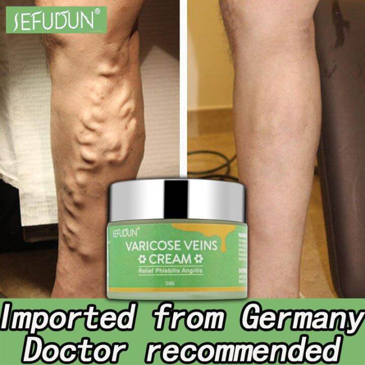 SEFUDUN Varicose Vein Treatment Cream Spider Vein Pain Varicosity ...