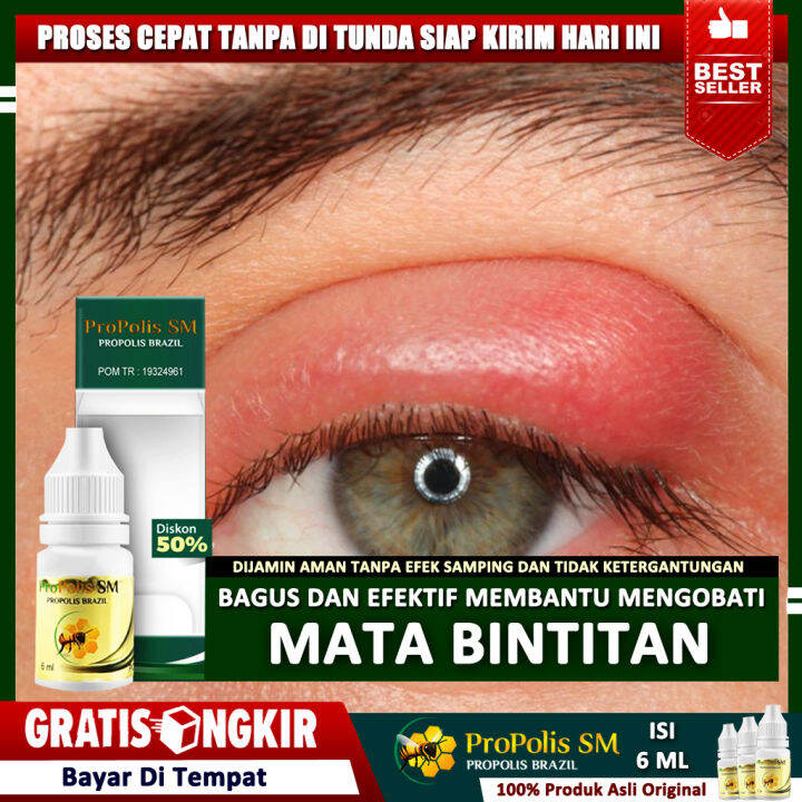 Obat Timbilen - Mata Timbilen - Penghilang Timbilan Di Mata - Mata ...