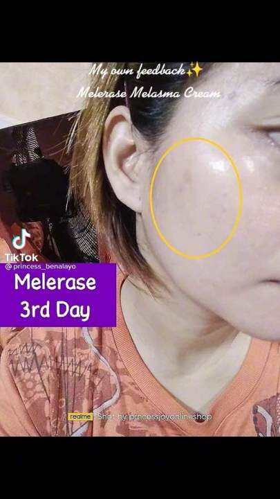 MELERASE MELASMA CREAM BY BELLEGLOW | Lazada PH