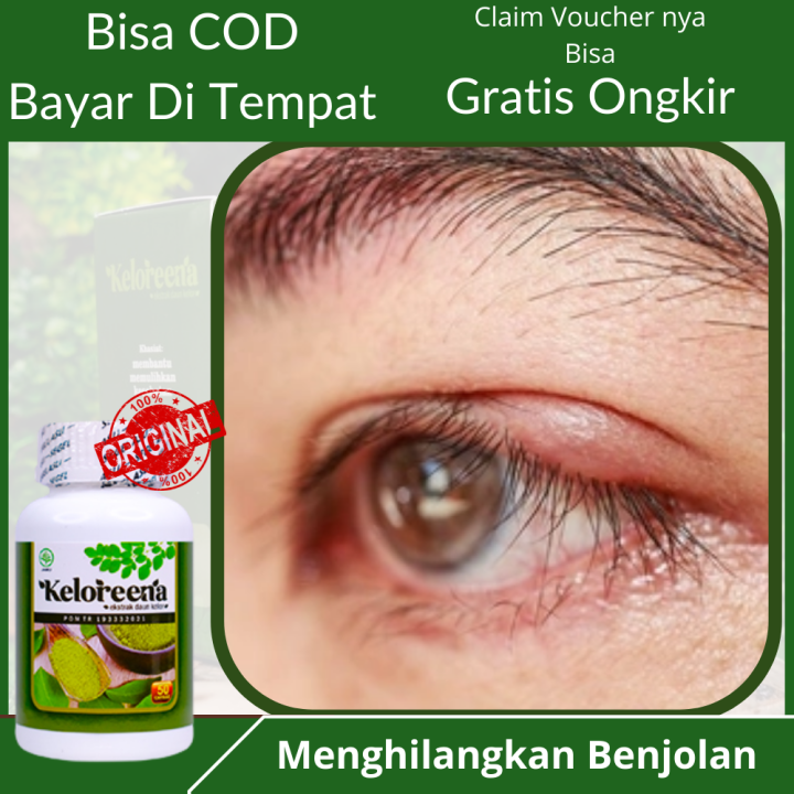 Obat Benjolan Di Kelopak Mata, Obat Herbal Untuk Menghilangkan Benjol ...