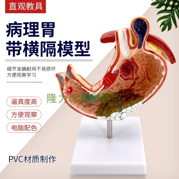 Gastric anatomy model gastric lesions in the stomach disease model ...