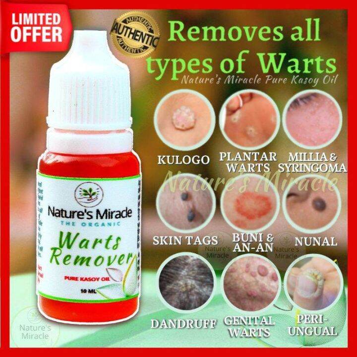 Nature's Miracle Warts Remover Mole Remover Skin Tag Remover Kasoy Oil ...