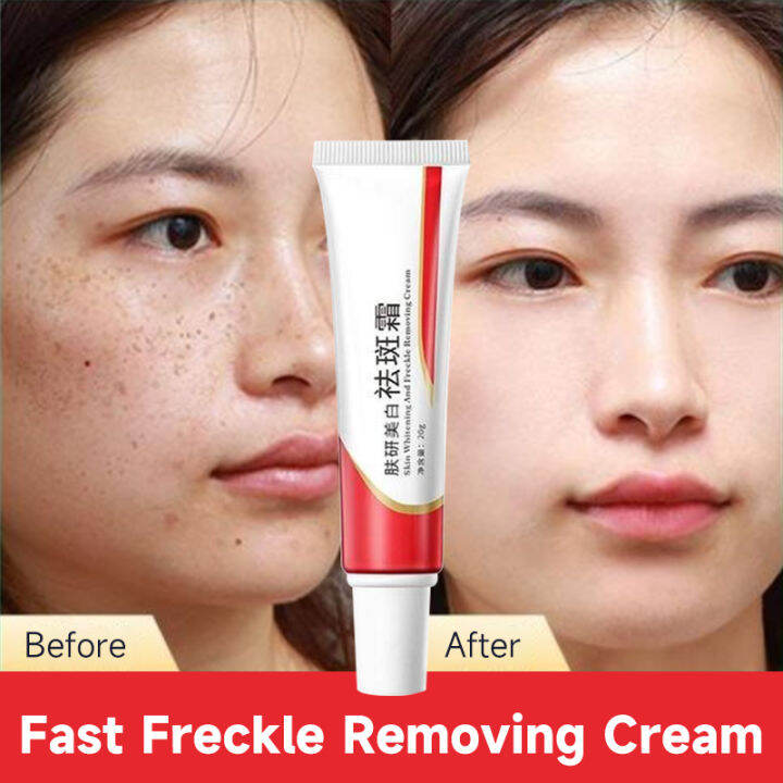 【Effective in 3 days】collagen melasma remover pekas remover cream ...