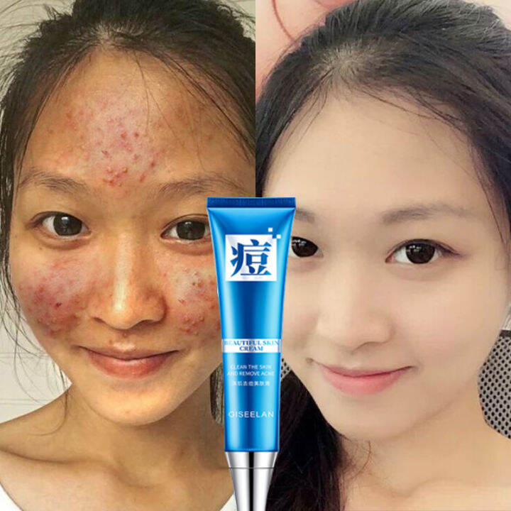 Anti Freckle Whitening Cream Powerful Removing Age Dark Spots ...