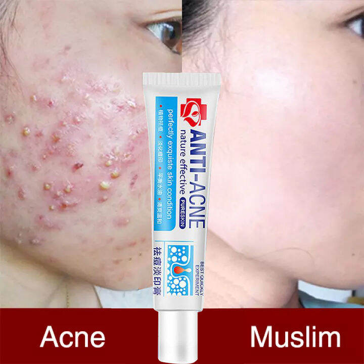 Remove Pimples Quickly Pimple Remover Acne Cream Fades Acne Marks Repairs Acne Pits Facial Scar ...