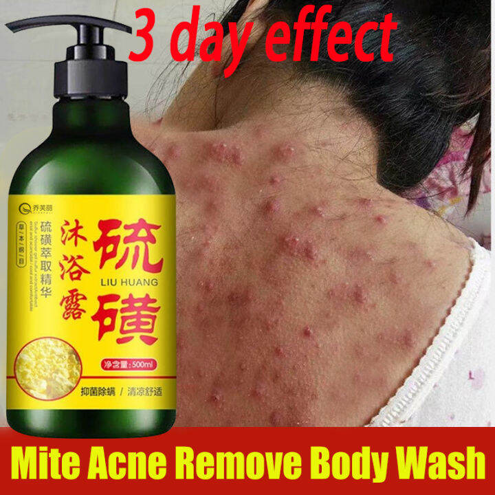 Sulfur Shower gel for men and women Anti-mite acne-prone Skin Repair ...