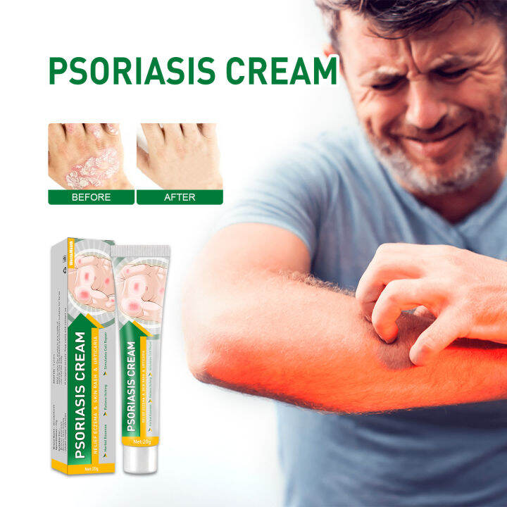 Psoriasis Cream Anti Itch Eczema Psoriasis Dermatitis Relieve Scalp