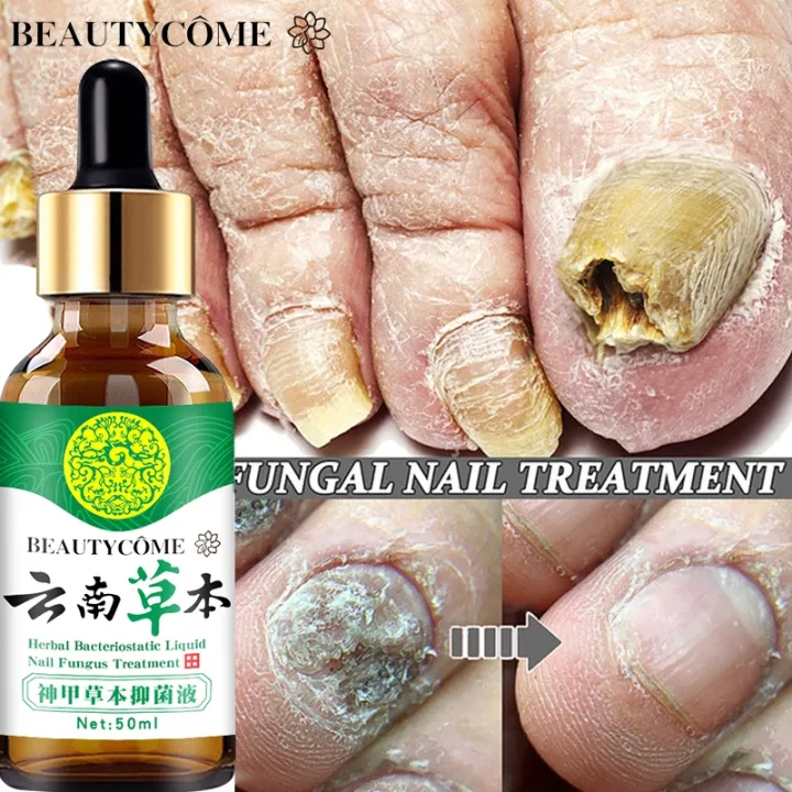 BEAUTYCOME Nail Repair Serum 10Ml-Initial Cure Fungal Nail Treatment ...