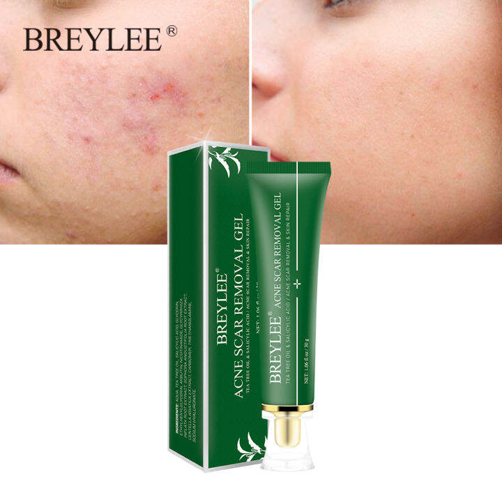 BREYLEE Acne Pimple Scar Removal Stretch Marks Pigmentation Treatment Essence Fades Dark Spots ...