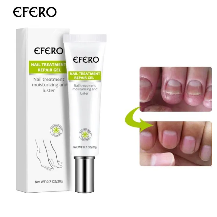 EFERO เซรั่มเชื้อราเล็บ,เซรั่มป้องกันเชื้อราเล็บเชื้อราที่เล็บเท้าให้ ...
