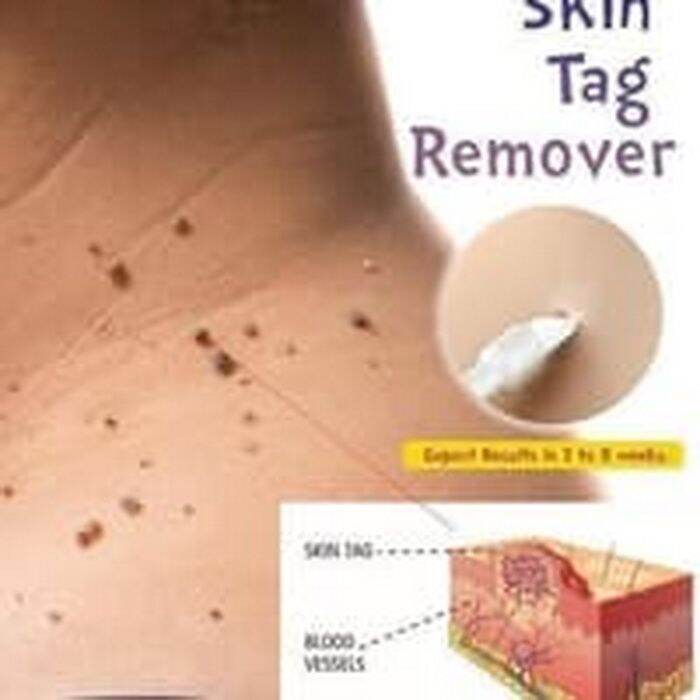 Skin Tag Remover Ampuh Atasi Noda Hitam, Kutil dan Mata Ikan | Lazada ...