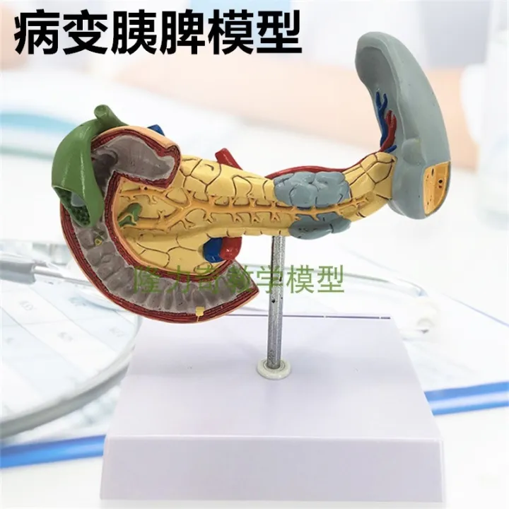 Medicine of pancreas duodenum gallbladder pathologic model bile stone ...