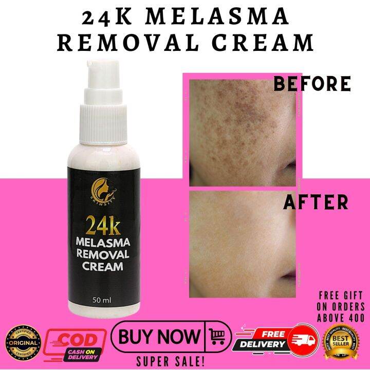 Original skinsity 24k melasma remover cream - remove acne, melasma ...