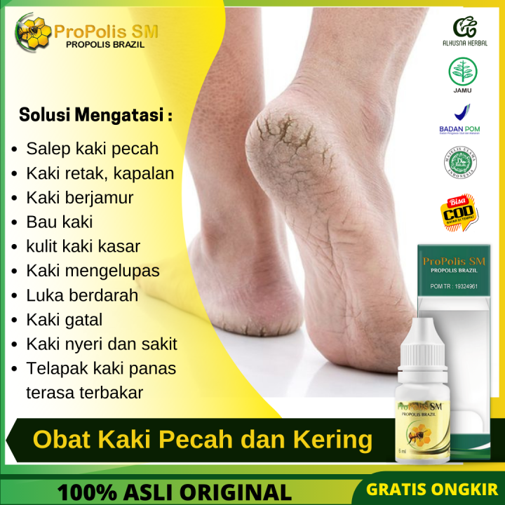 Obat Kaki Pecah dan Kering dgn PROPOLIS SM 100% ALAMI - Obat Salep kaki pecah pecah, kaki ...