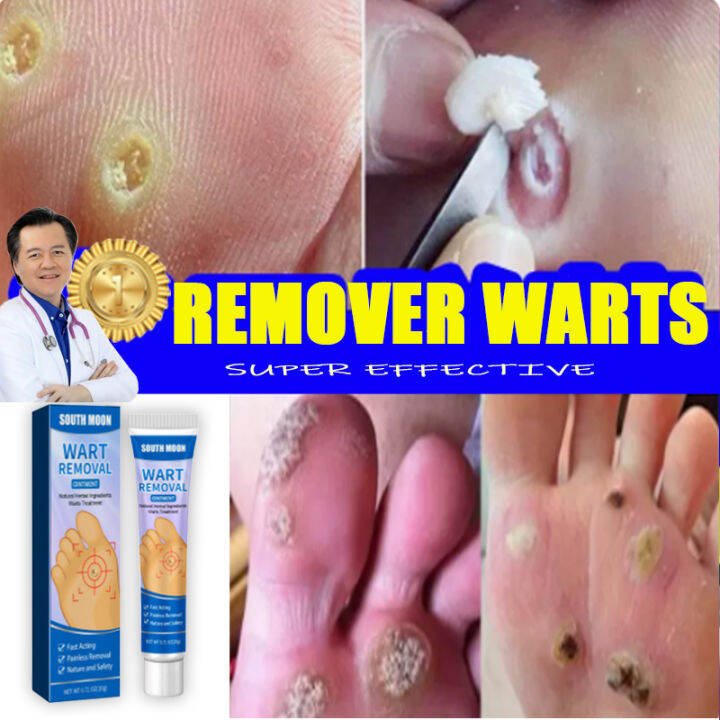 warts remover original cream painless warts removal skin tags and warts ...