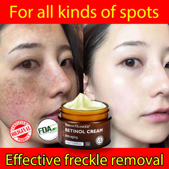 100% Original scannable QR code Melasma Cream 30g Original Melasma And ...