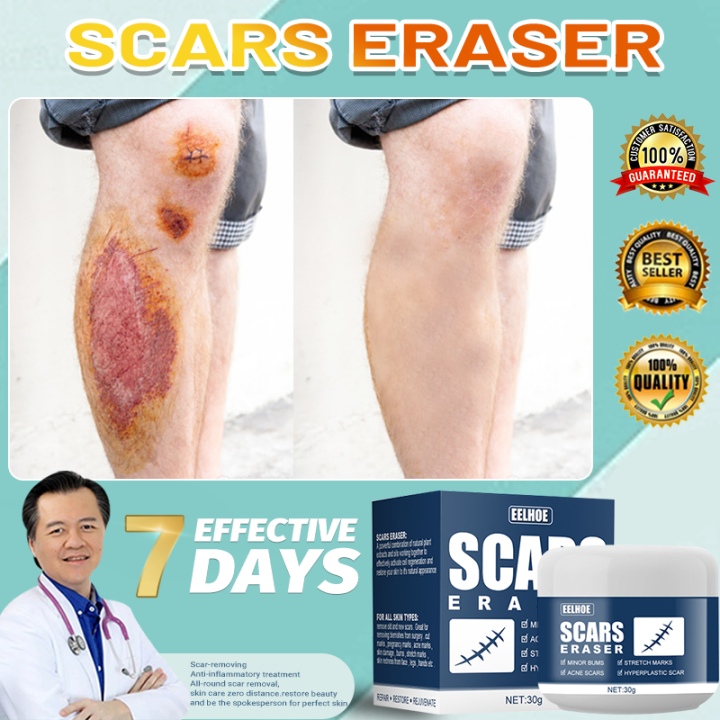 fix scar removal original scar gel by doc willie ong scar remover scars ...