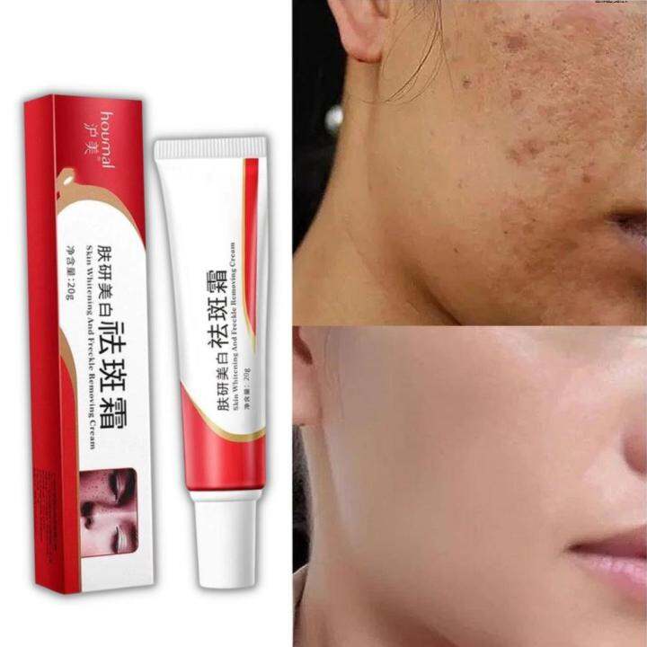 Pimple Cream Oxecure Pimple Cream For Men Pimple Cream Acne Care ♤yanjiayi 20g Freckle Cream