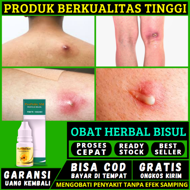 Obat Bisul Bernanah Di Kaki Selangkangan Pantat Jidak Ketiak Wajah ...