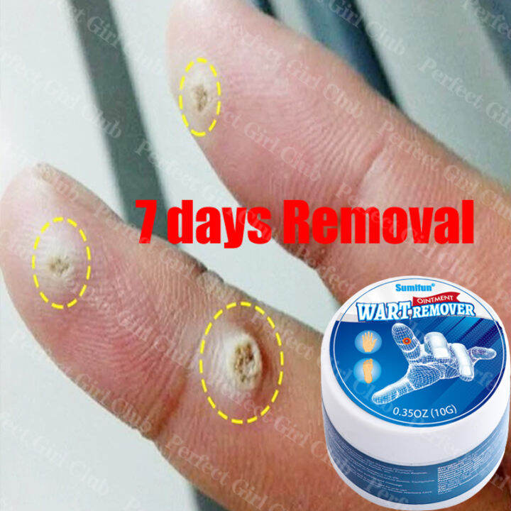 7 days Effective Original SUMIFUN Warts Remover Cream 10g No Pain Warts ...