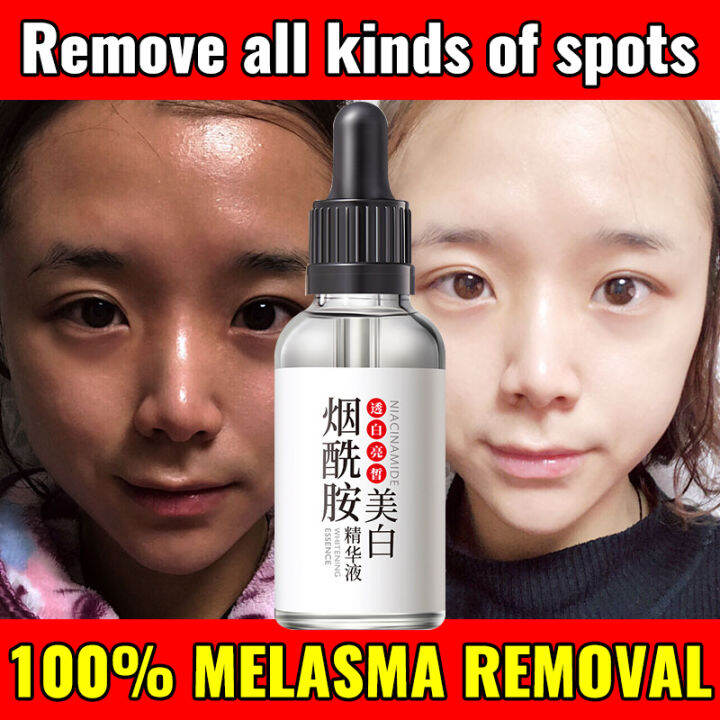 Melasma and pekas remover serum, dark spot remover for face melasma ...