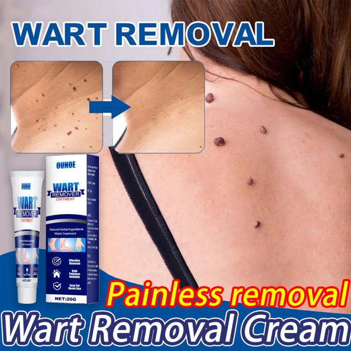 【Original authentic+COD】 OUHOE wart cream Skin scar removal cream Warts ...