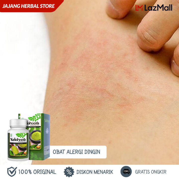 Obat Alergi Dingin Kulit Gatal Bentol Seluruh Badan, Biduran, Menahun ...