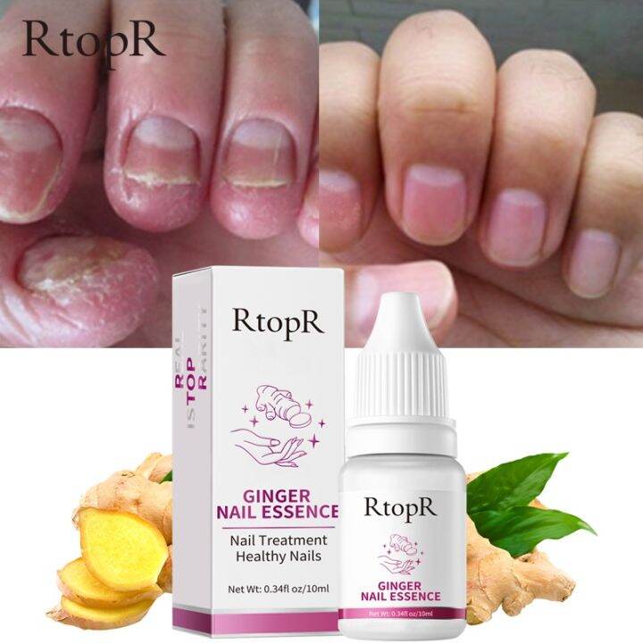 RtopR Ginger Antibacterial Nail Treatment Essential Anti Fungal ...