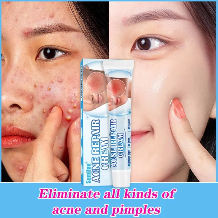 Remove Pimples Quickly Pimple Remover Acne Cream Fades Acne Marks Repairs Acne Pits Facial Scar ...