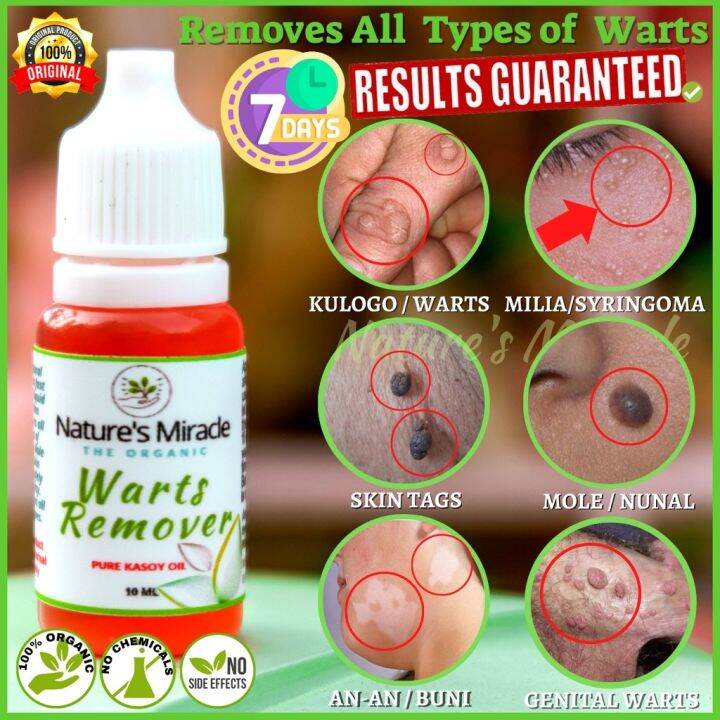 Warts Remover Kasoy Oil Warts Remover Original Mole Remover Kulogo Buni ...