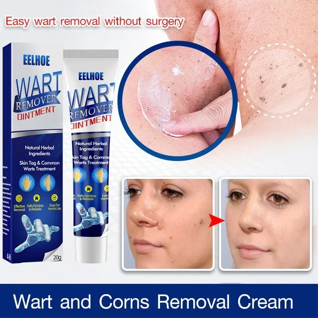 viviunice [SFDA approval number] Wart and Corns Removal Cream | Lazada PH
