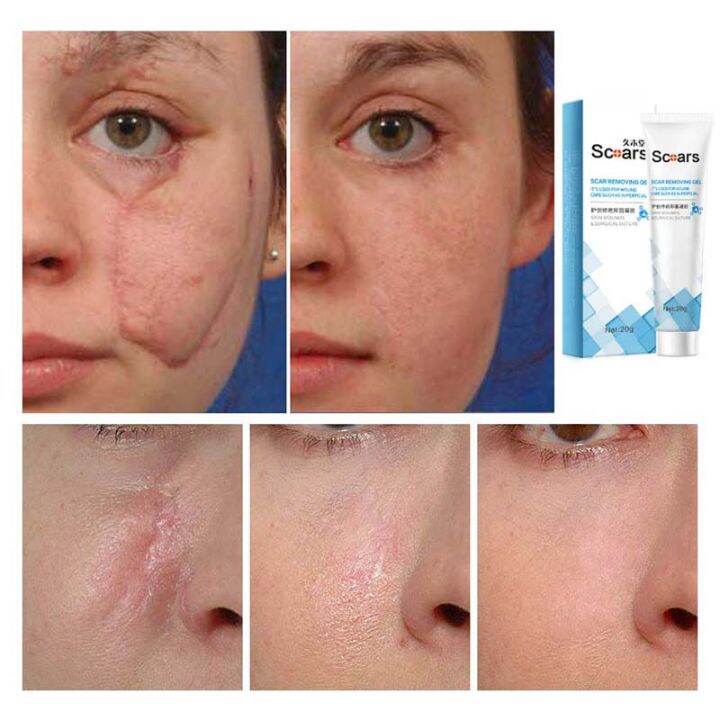Scar Repair Cream Lightening Scar Cream Repair Acne Old Scar Caesarean ...
