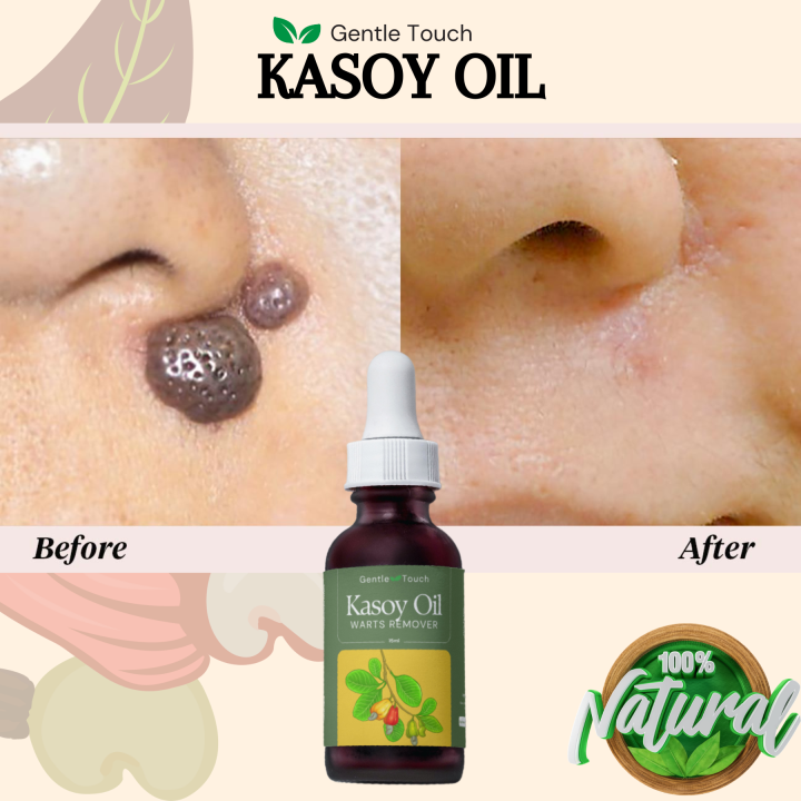 🌼[Gentle Touch] Pure Kasoy Oil(15ml) with Salicylic Acid and Aloe Vera ...