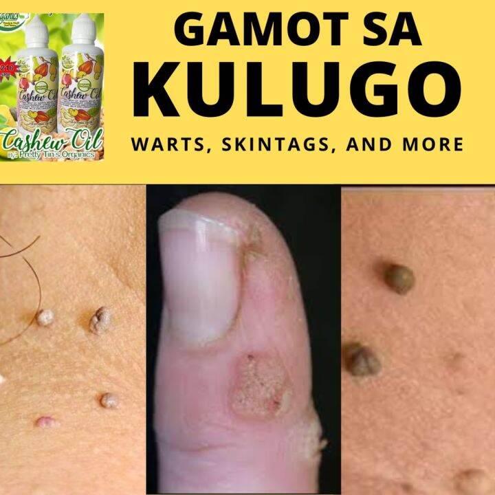 CASHEW OIL (GAMOT SA KULUGO, WARTS, SKINTAGS AT IBA PA) by Pretty Tin's ...