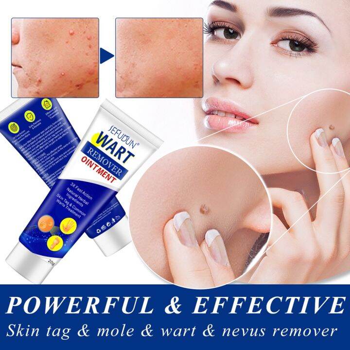 SEFUDUN Painless Warts Remover Ointment Cream Effectively Remove Skin ...
