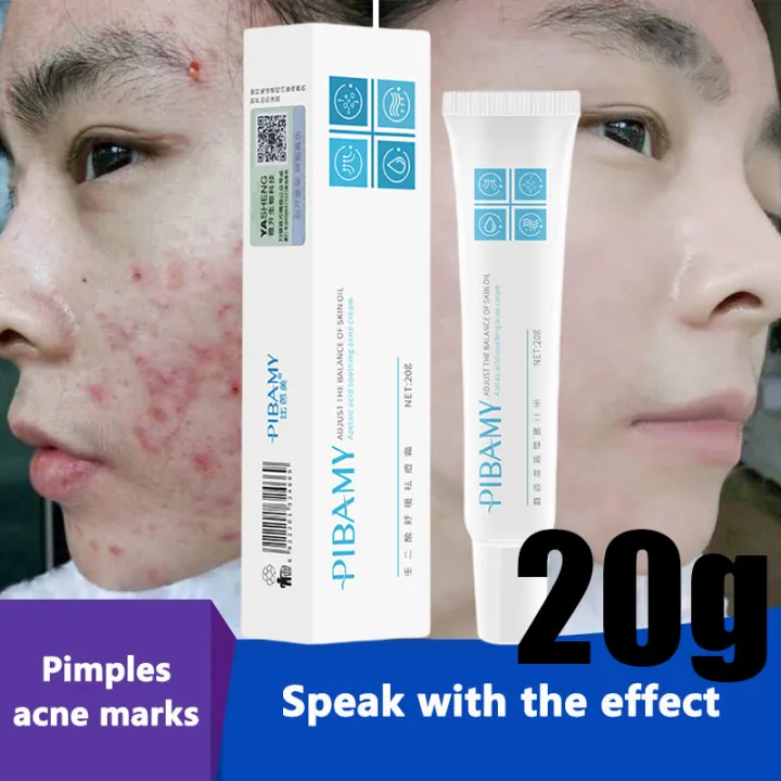 Pimple marks remover Pimple Remover Acne Cream Acne Pimples Remover ...