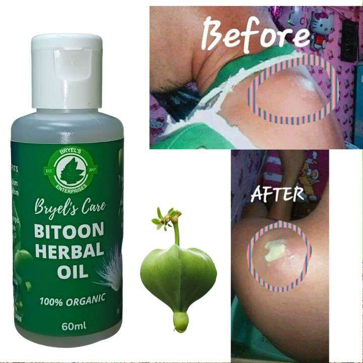 🌿🌿BRYELS CARE BITOON HERBAL OIL 60ML ANTI BODY BUMPS 🌿Mabisang Pangtunaw sa Lahat ng Uri ng mga ...