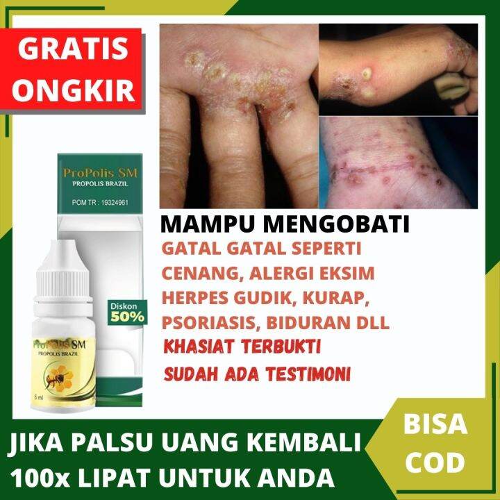 Obat Gatal Air Dan Bernanah - Infeksi Kulit - Bintik Merah Pada Kulit ...