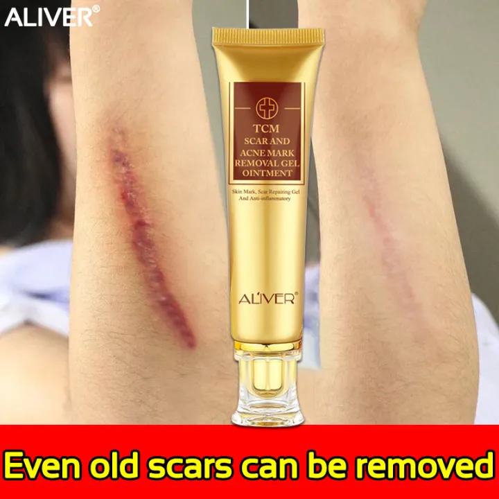 No surgery required to remove scars!Aliver scar gel 30g Removes various ...
