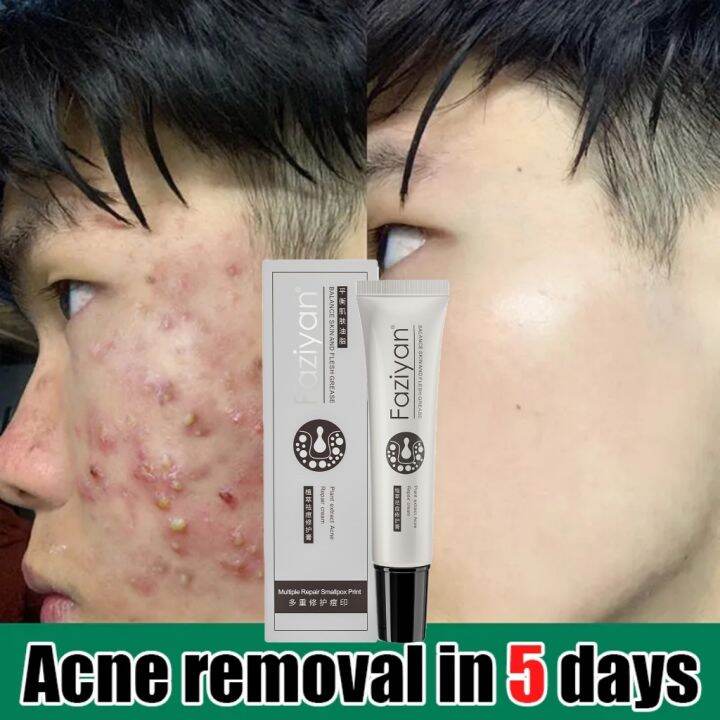 🔥Effective in 5 Days🔥acne pimple cream original remover for men fades acne marks acne scars ...